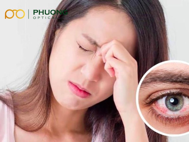 Bệnh Đau Mắt Đỏ: Triệu Chứng, Nguyên Nhân Và Lưu Ý Cần Biết - Phuongoptical